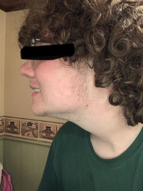 Whys My Jaw So Weird R Jawsurgery