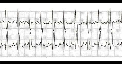 Afib Flutter Sqlpoliz