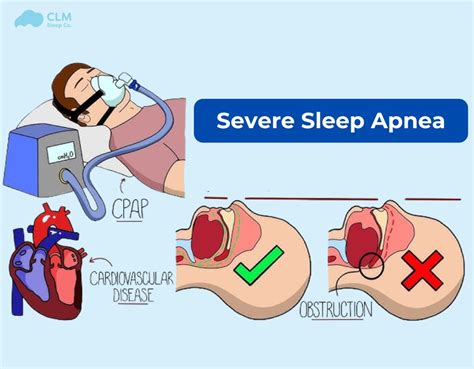 Sleep Apnoea
