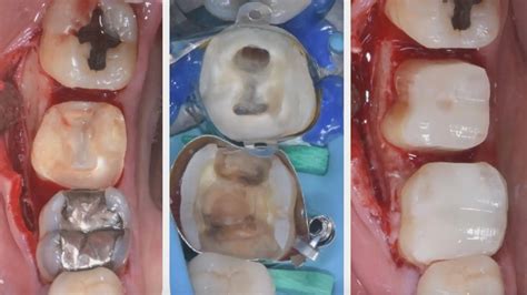 Clinical Procedures For Indirect Restorations With Sub Gingival Margins