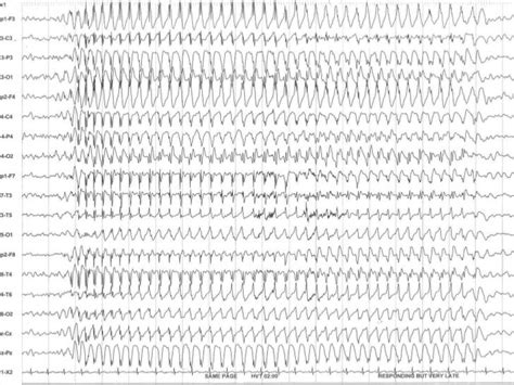 Abnormal Eeg Patterns