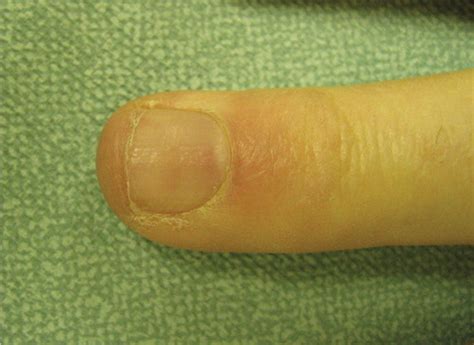 Pyogenic Granuloma Finger