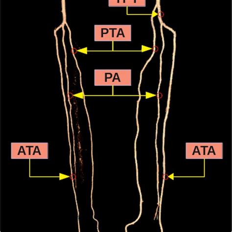 Popliteal Artery Branching Patterns Download Scientific Diagram