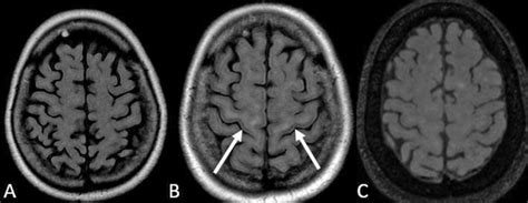 A Baseline Mri In Flair Sequence B Flair Sequence On Day 154 Download Scientific Diagram