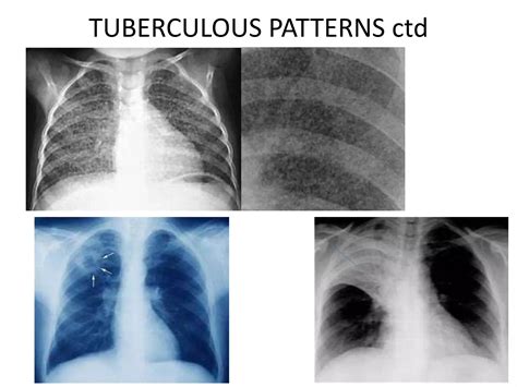 Cxr Interpretation In Tb Patients Ppt Free Download