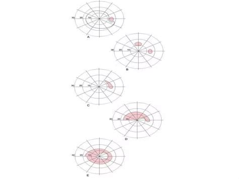 Visual Field Defects PPTX