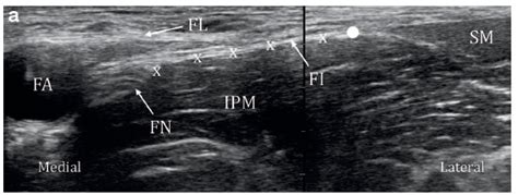 Fascia Iliaca Compartment Block An Update Wfsa Resources