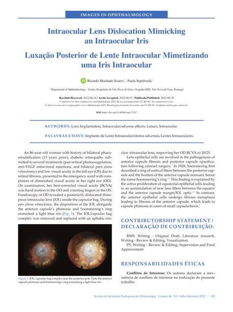 Pdf Intraocular Lens Dislocation Mimicking An Intraocular Iris