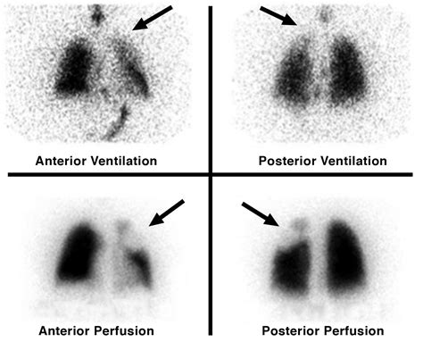 What Is A Lung Perfusion Scan At Michelle Bishop Blog