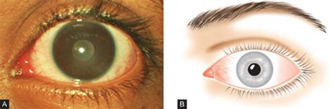 Angular Conjunctivitis