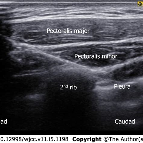Ultrasonography Of Intercostobrachial Nerve Block Download Scientific Diagram