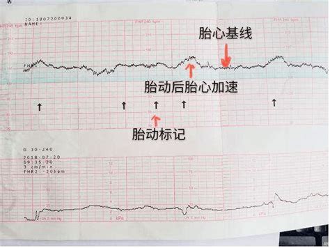 胎心监护图怎么看？这几个数据看懂，自己就能了解胎儿的健康情况 搜狐大视野 搜狐新闻