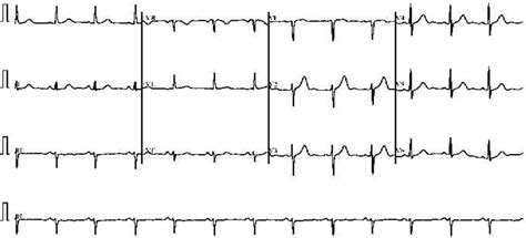 figure 1 from digitizing ecg signal using 2d signal convolution