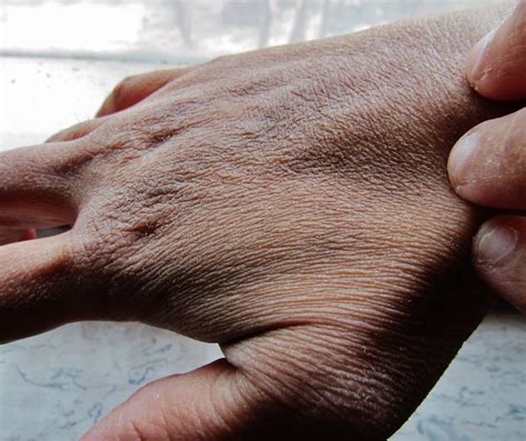 Dry Winter Hands The Derm Np