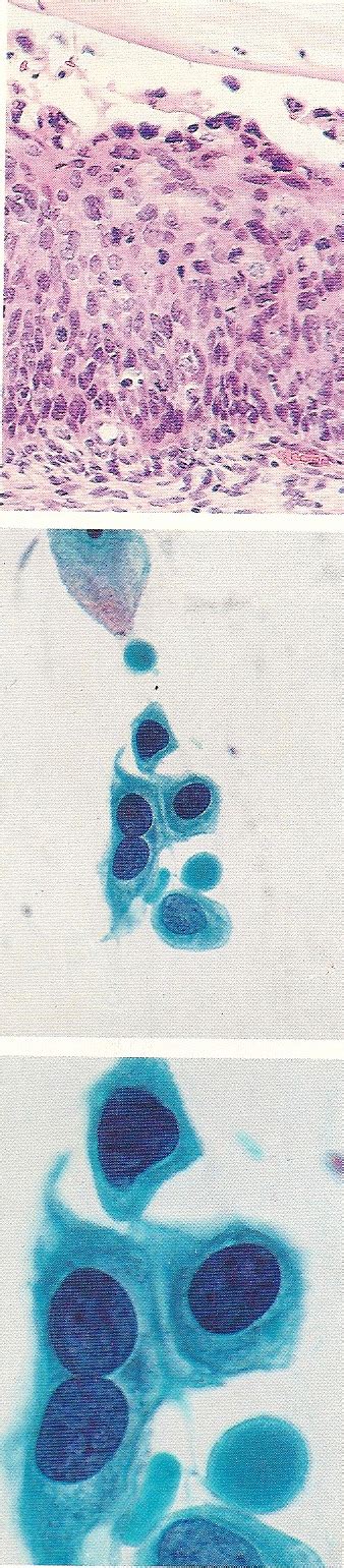 정보광장 자료실 의학 자궁경부이형성증