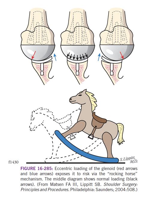 Shoulder Arthritis Joint Replacement Glenoid Component Loosening Relationship To Surface