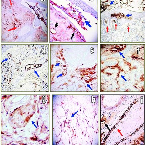 Atypical Ihc Staining Patterns Seen In Abds A Complement C3c Positive