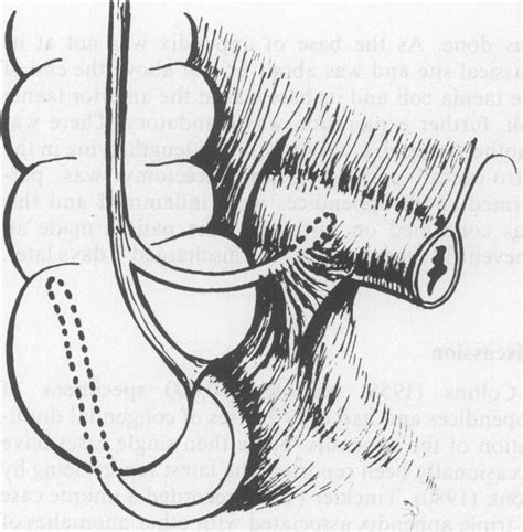 Appendix Vermiformis Duplex Download Scientific Diagram
