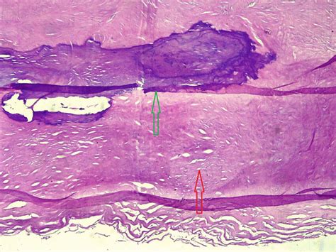 Histopathology Section Showing Eggshell Calcification Green Arrow Download Scientific Diagram