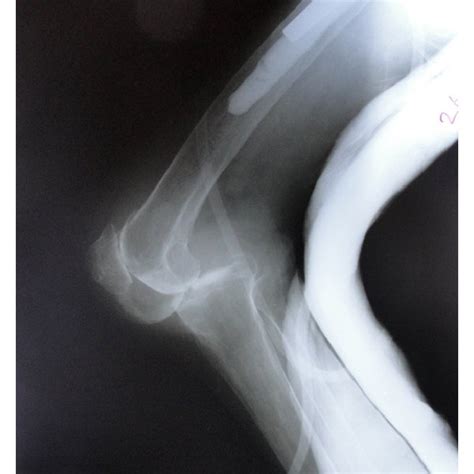 Posterior Knee Dislocation Seen On Radiography Before And After