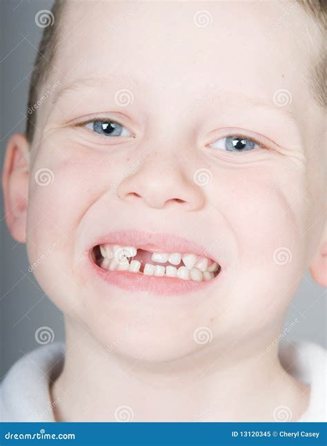 Missing Front Tooth Stock Image Image Of Dental Cute