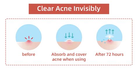 Can Pimple Patches Be Used Daily