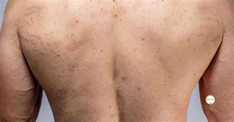 Pityriasis Rosea Rash Symptoms Diagnosis And Treatment Dcsi