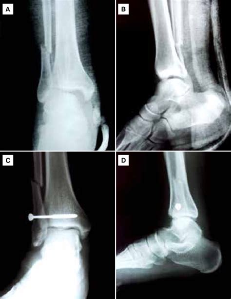 A And B Weber C Ankle Fracture With Tibiofibular Diastasis C And Download Scientific