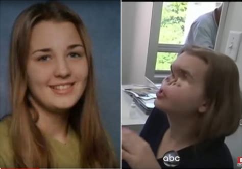 Drugar Joj Je Puškom Pijan Razneo Dve Trećine Lica A Onda Je 10 Godina Kasnije Dobila Novo