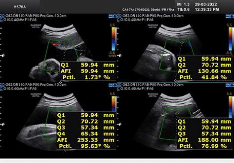 Everything You Need To Know About Amniotic Fluid Index Full Article