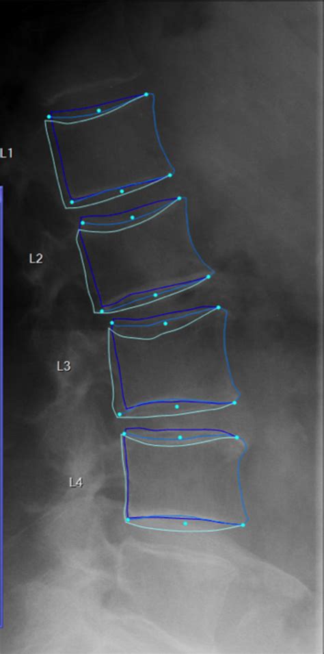 The Result Of Semi Automated Quantitative Vertebral Morphometry Of L1 Download Scientific