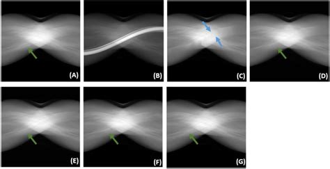 Sinogram Visual Comparison Of Case 3 In Fig 4 Using Different Sinogram Download Scientific