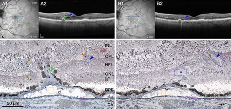 Residual Intraretinal Exudative Fluid Green Lines On Near Infrared Download Scientific Diagram