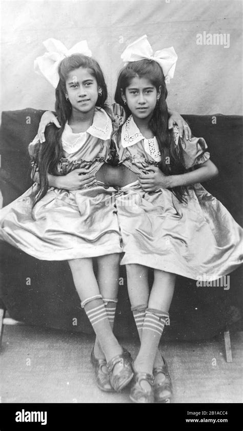 Siamese Twins Maria And Arrita Anna 1907 1929 C 1920 Some Sources