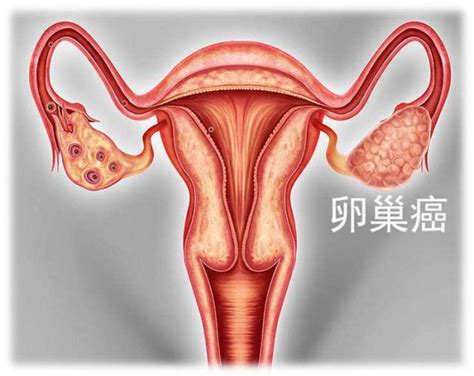 每种疾病都有先兆 揭秘卵巢癌的初期症状