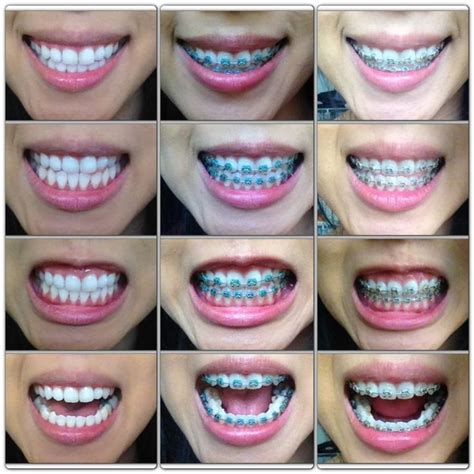 Best Color Rubber Bands For Braces Warehouse Of Ideas