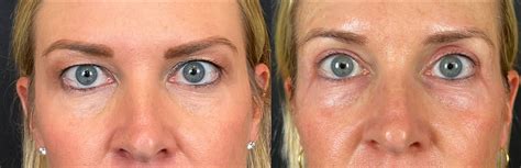 Benefits Of A Blepharoplasty For Hooded Eyes Schlessinger Eye And Face