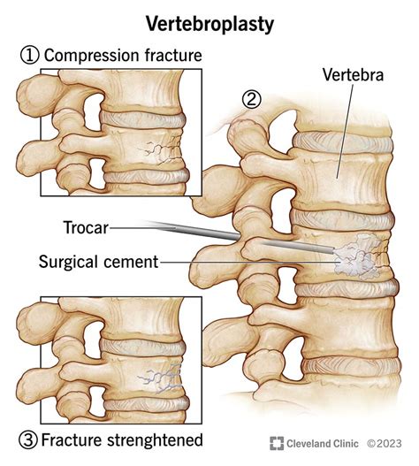 Vertebroplasty What It Is Purpose Procedure And Side Effects