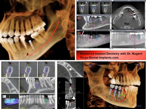 Dental Implant Surgery With Cbct Cone Beam 3d Implants