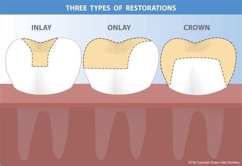 Inlay Vs Onlay Vs Crown Medizzy