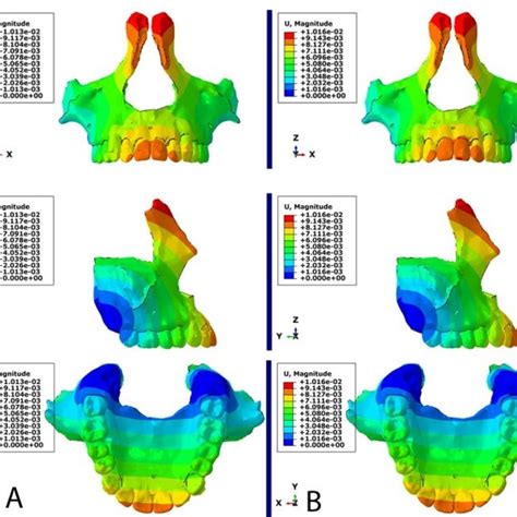Model B Maxillary Model With Acrylic Occlusal Intrusion Splint With Hooks Download