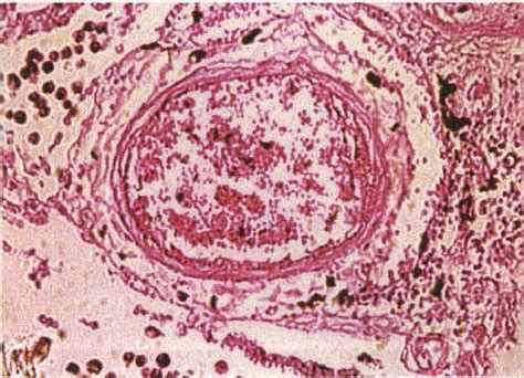 图3 3 动脉充血 病理组织 图片