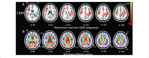 Tract Based Spatial Statistics Tbss Analysis Of White Matter Download Scientific Diagram