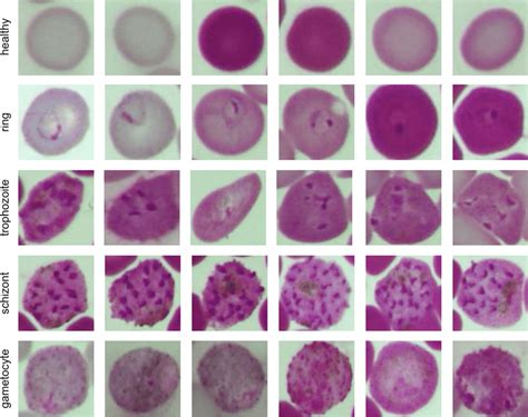 Plasmodium Malariae Ring Stage
