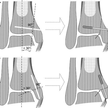 Schematic Drawings Of Wrong Techniques In Which The Osteotomy Angle Is Download Scientific