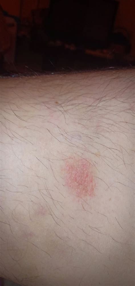 Красное пятно на ноге шелушится фото