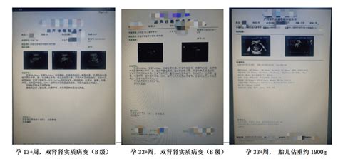Ckd4 期患者可以怀孕吗？一文理清 Ckd 与妊娠肾脏血压超声
