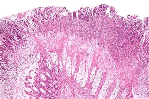 Pseudomembranous Colitis Libre Pathology