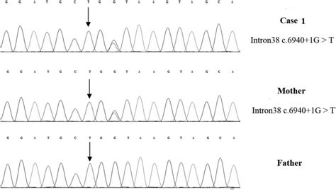 Vps13b Intron38 C 6940 1g T Heterozygous Mutation In Case 1 Carried Download Scientific