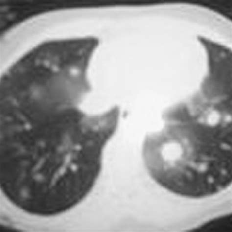 Chest Computed Tomography Showed Multiple Round Nodules Download Scientific Diagram